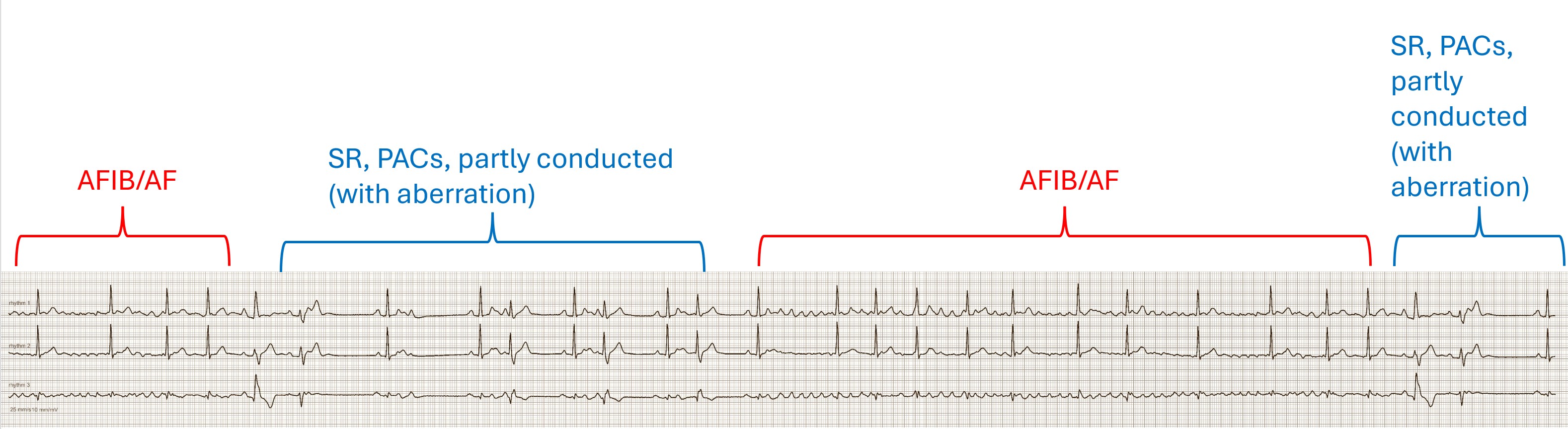 Atrial Flutter Ecg Guru Instructor Resources
